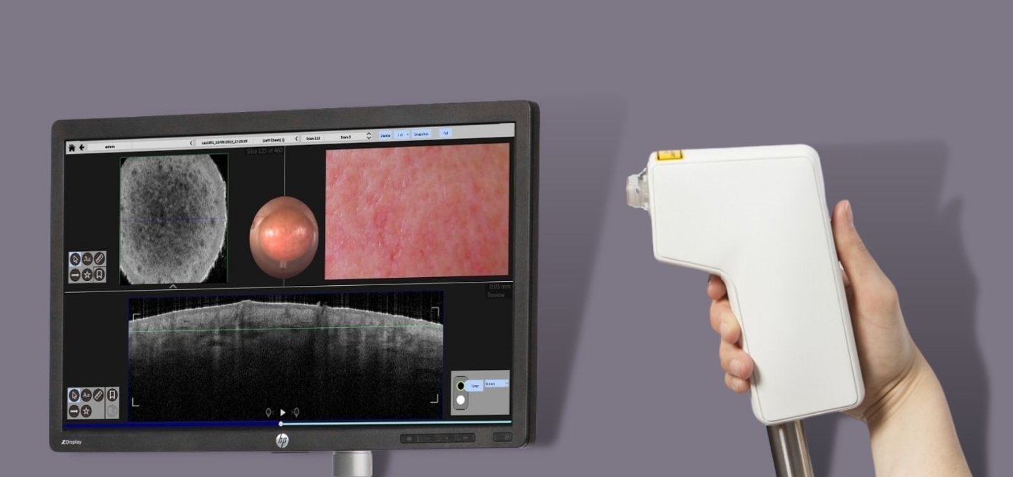 Optische Kohärenztomographie für präzise Hautdiagnose | VivoSight OCT